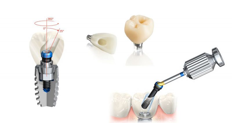 CROWNS ATTACHED TO IMPLANTS - Dental Oral Centar