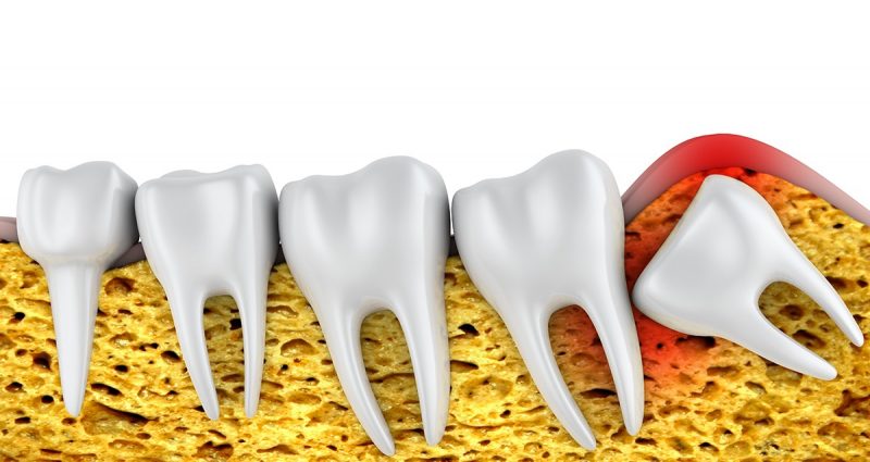 VAĐENJE UMNJAKA - Dental Oral Centar