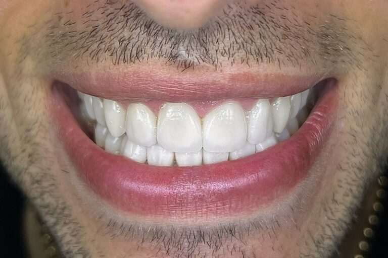 KERAMIČKE FASETE - Dental Oral Centar