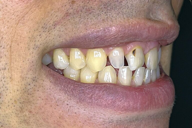 KERAMIČKE FASETE - Dental Oral Centar